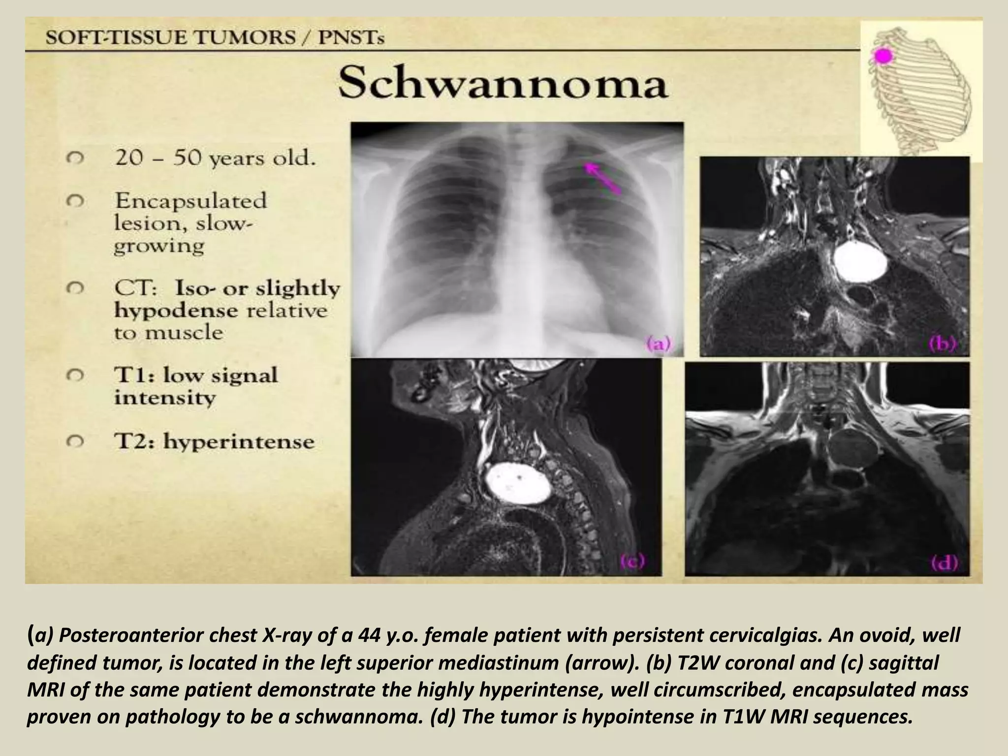 Presentation1, radiological imaging of chest wall tumour. | PPT