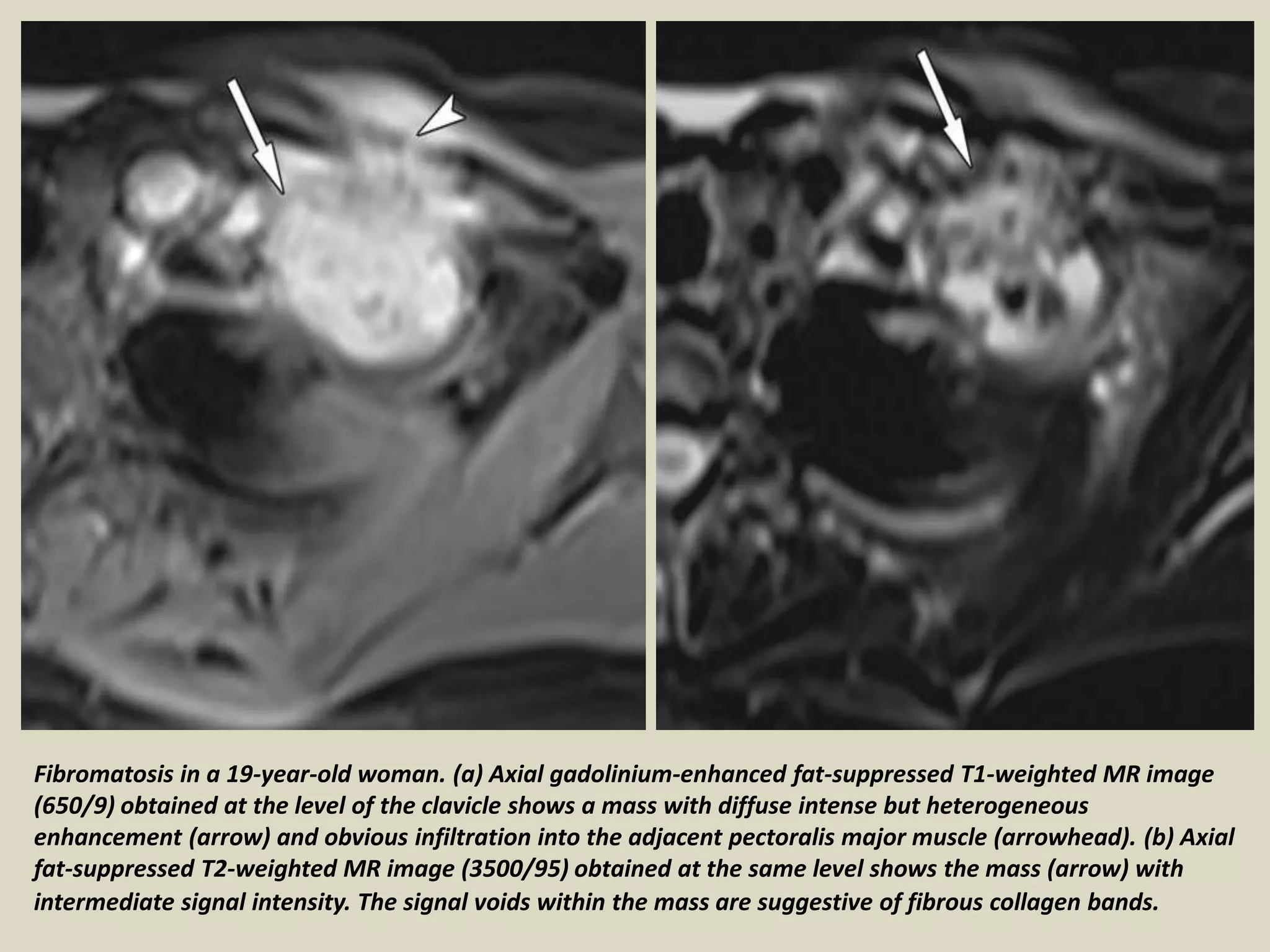 Presentation1, radiological imaging of chest wall tumour. | PPTX