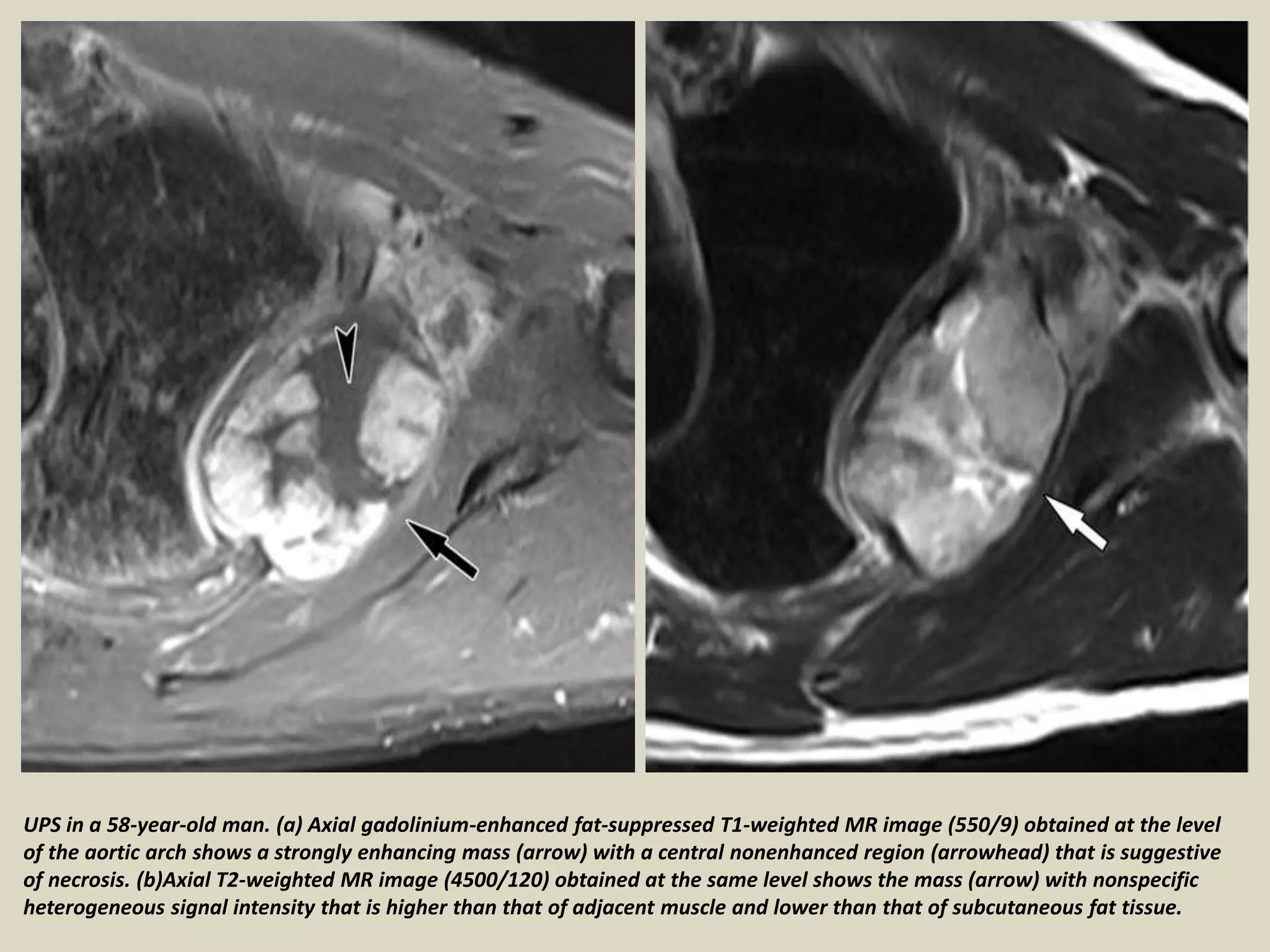 Presentation1, radiological imaging of chest wall tumour. | PPTX