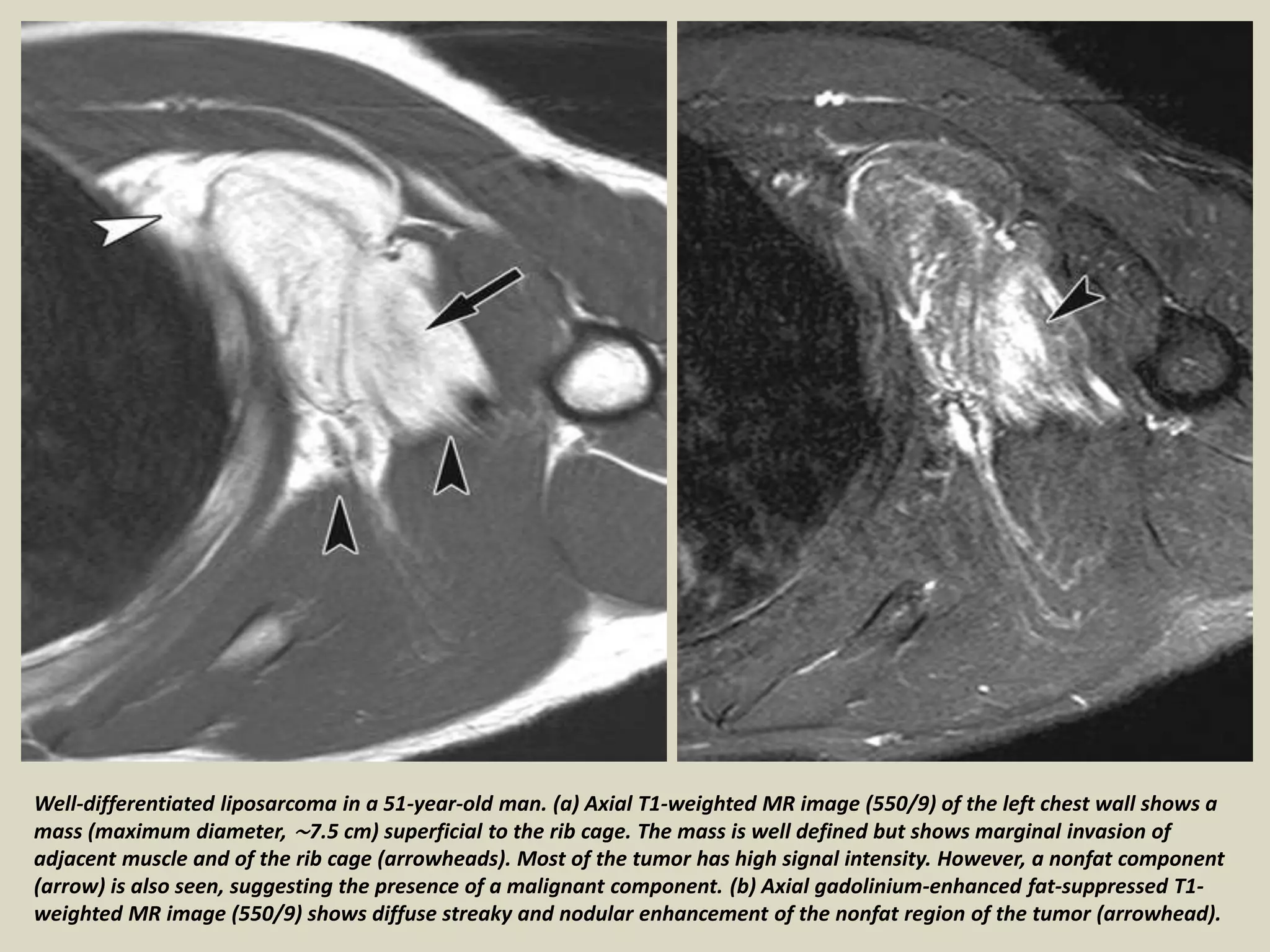 Presentation1, radiological imaging of chest wall tumour. | PPT