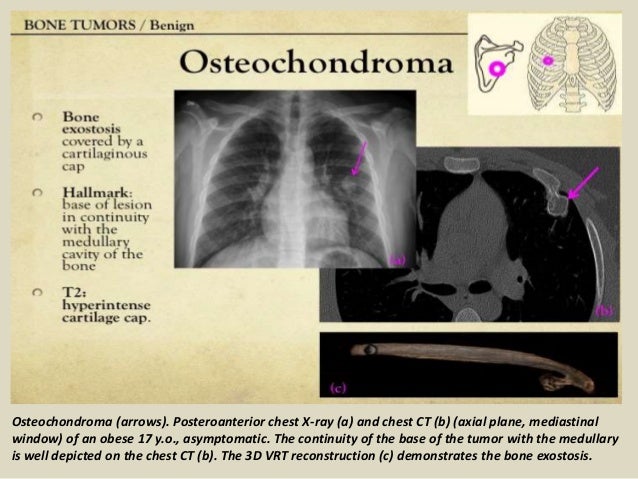 Presentation1, radiological imaging of chest wall tumour.