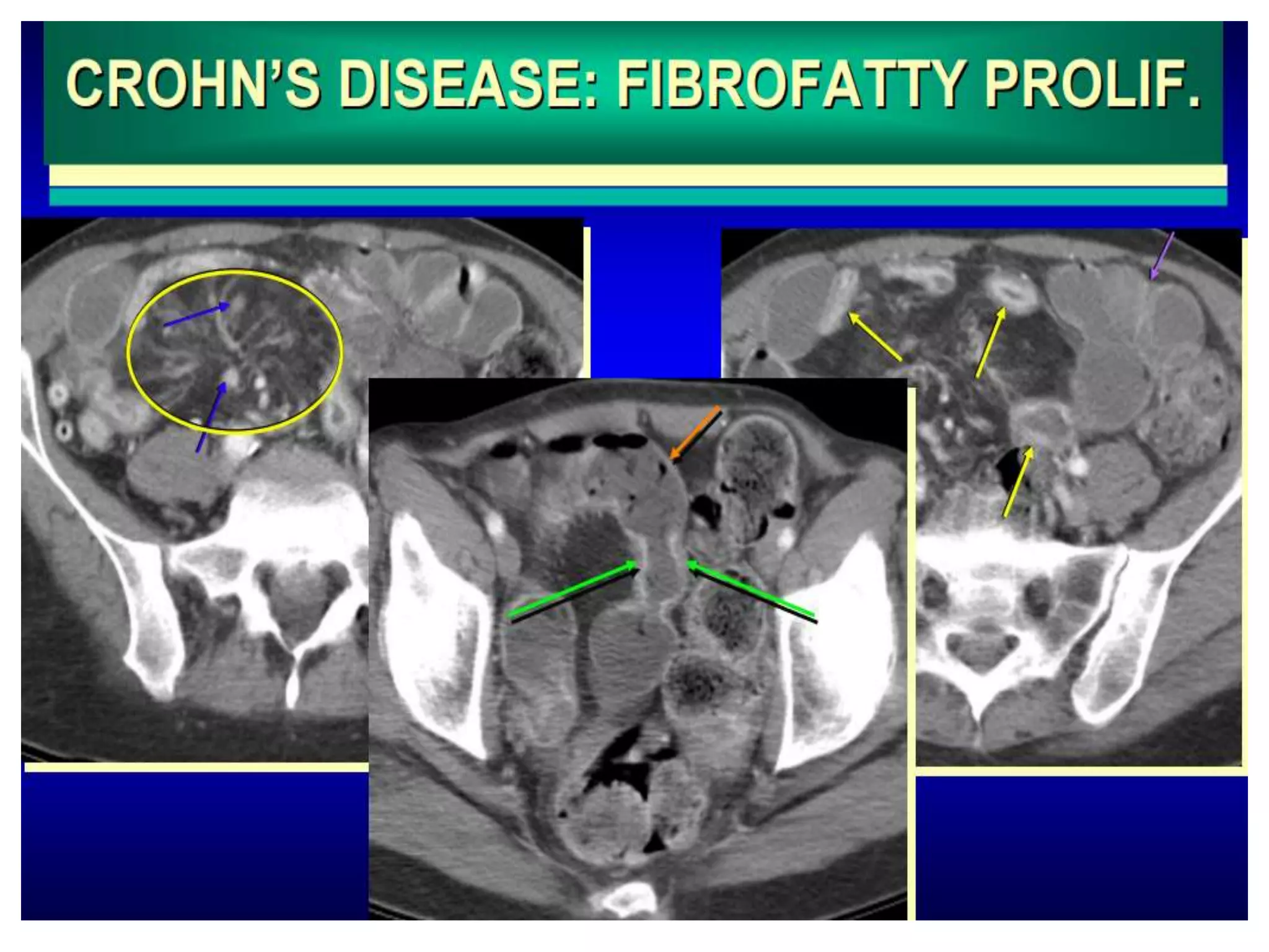 Presentation1, radiological imaging of colitis. | PPTX