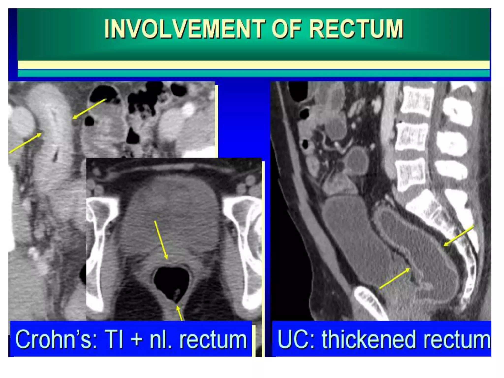Presentation1, radiological imaging of colitis. | PPTX