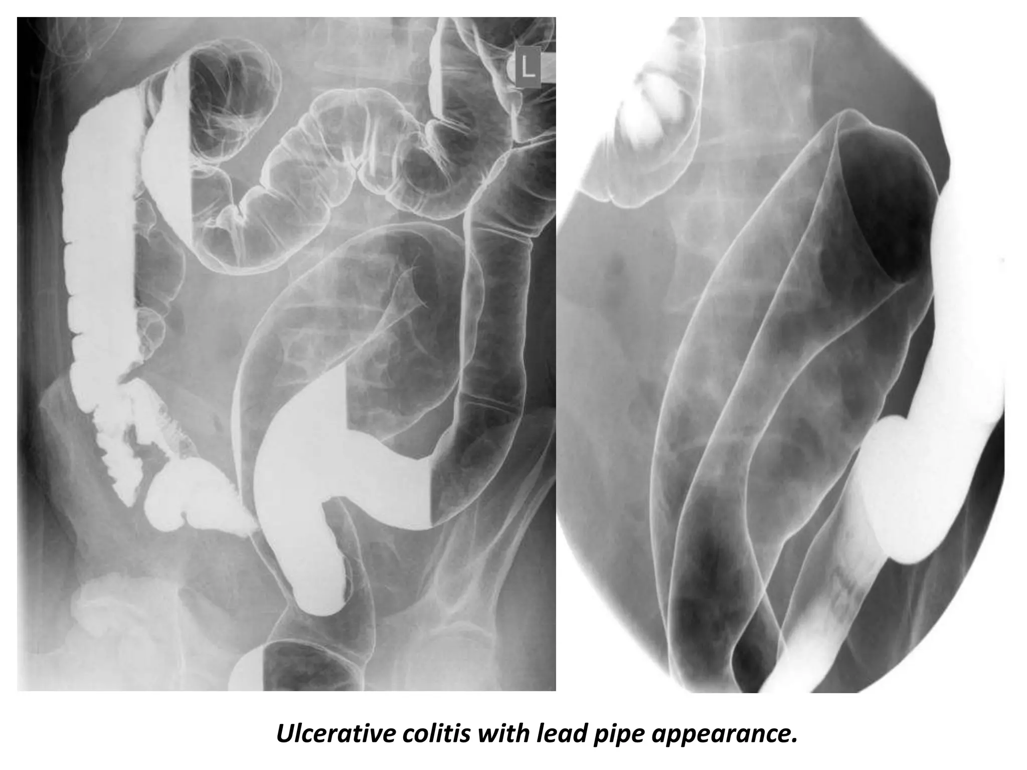 Presentation1, radiological imaging of colitis. | PPTX