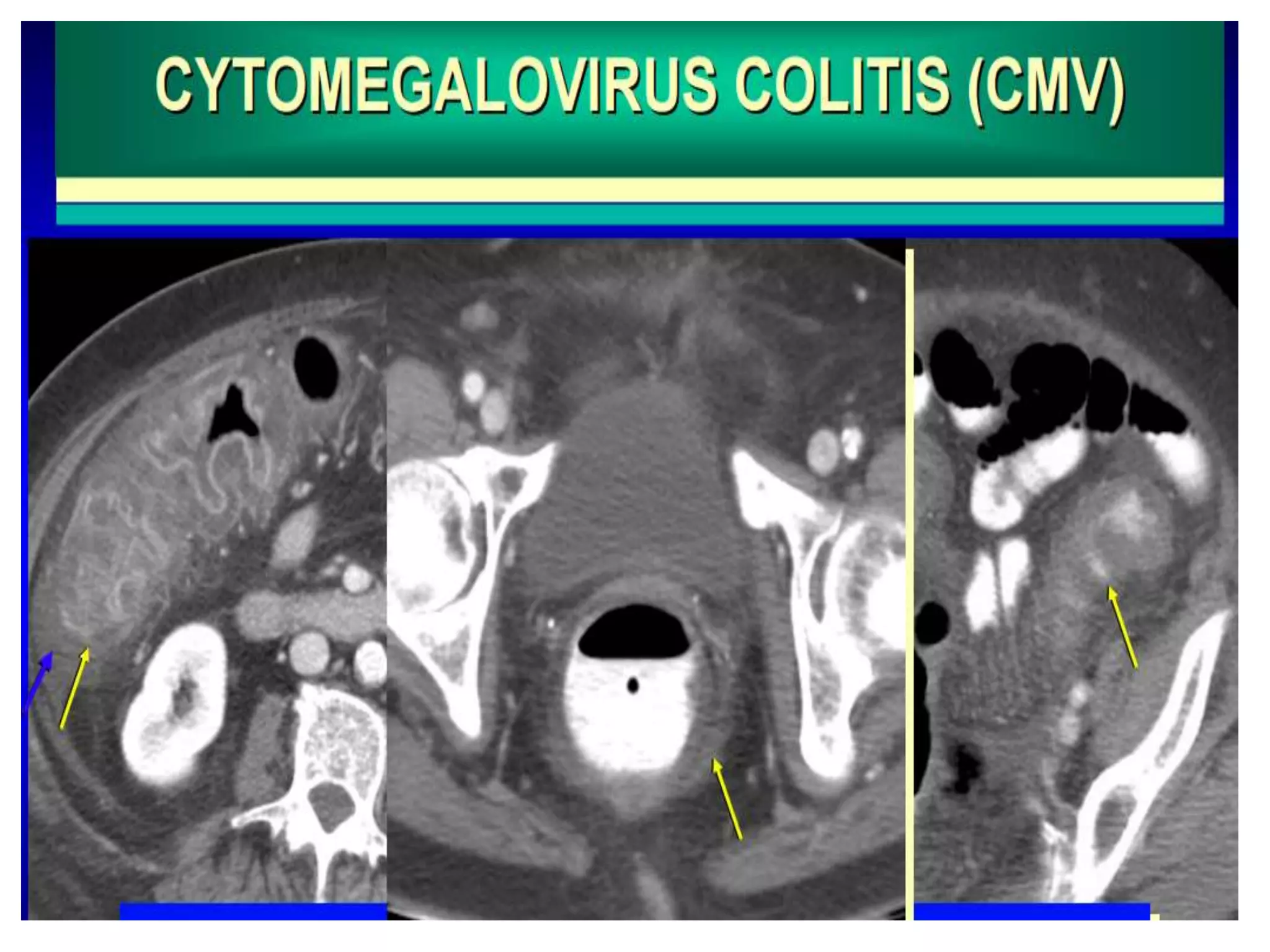 Presentation1, radiological imaging of colitis. | PPTX