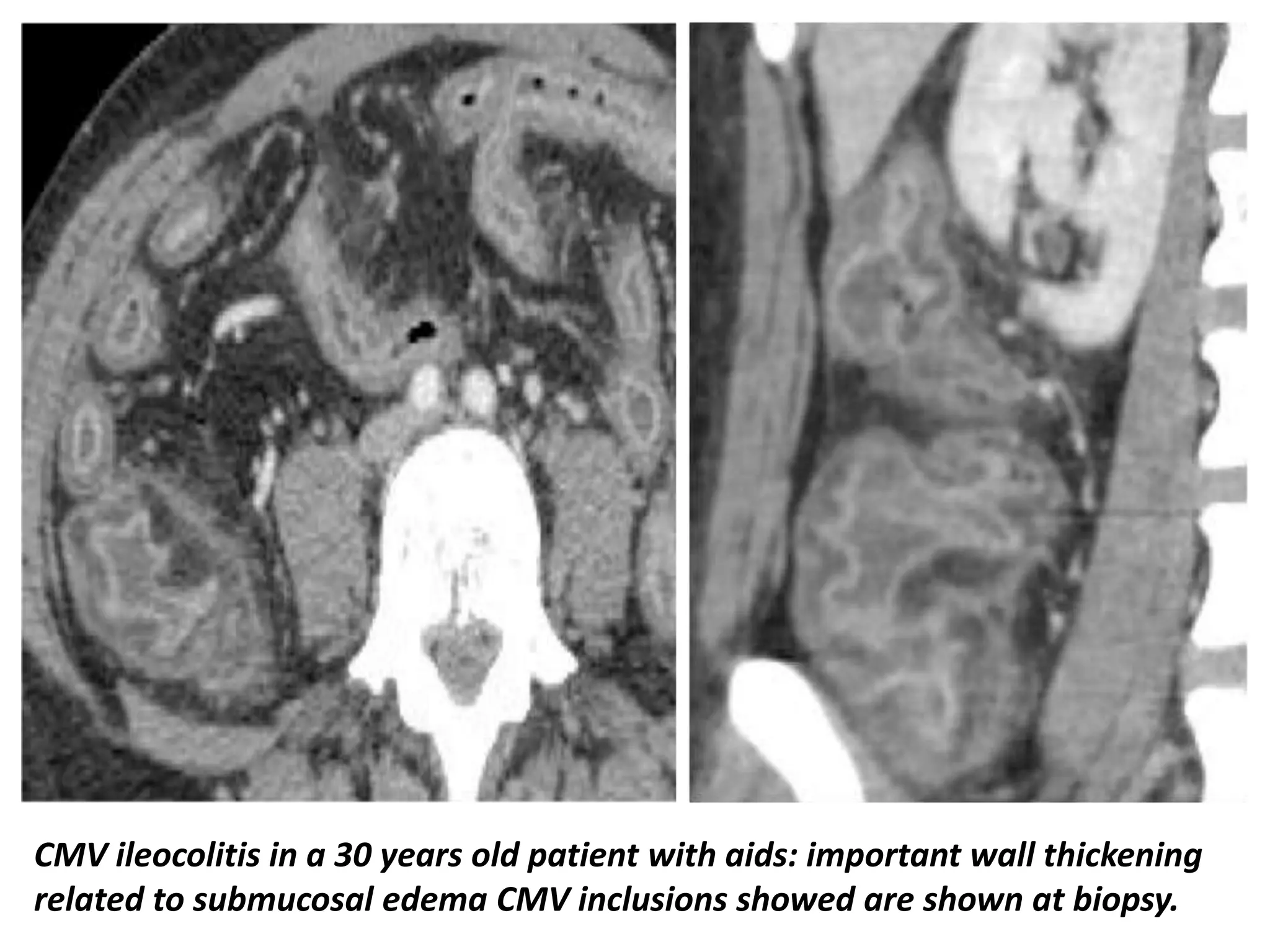 Presentation1, radiological imaging of colitis. | PPTX