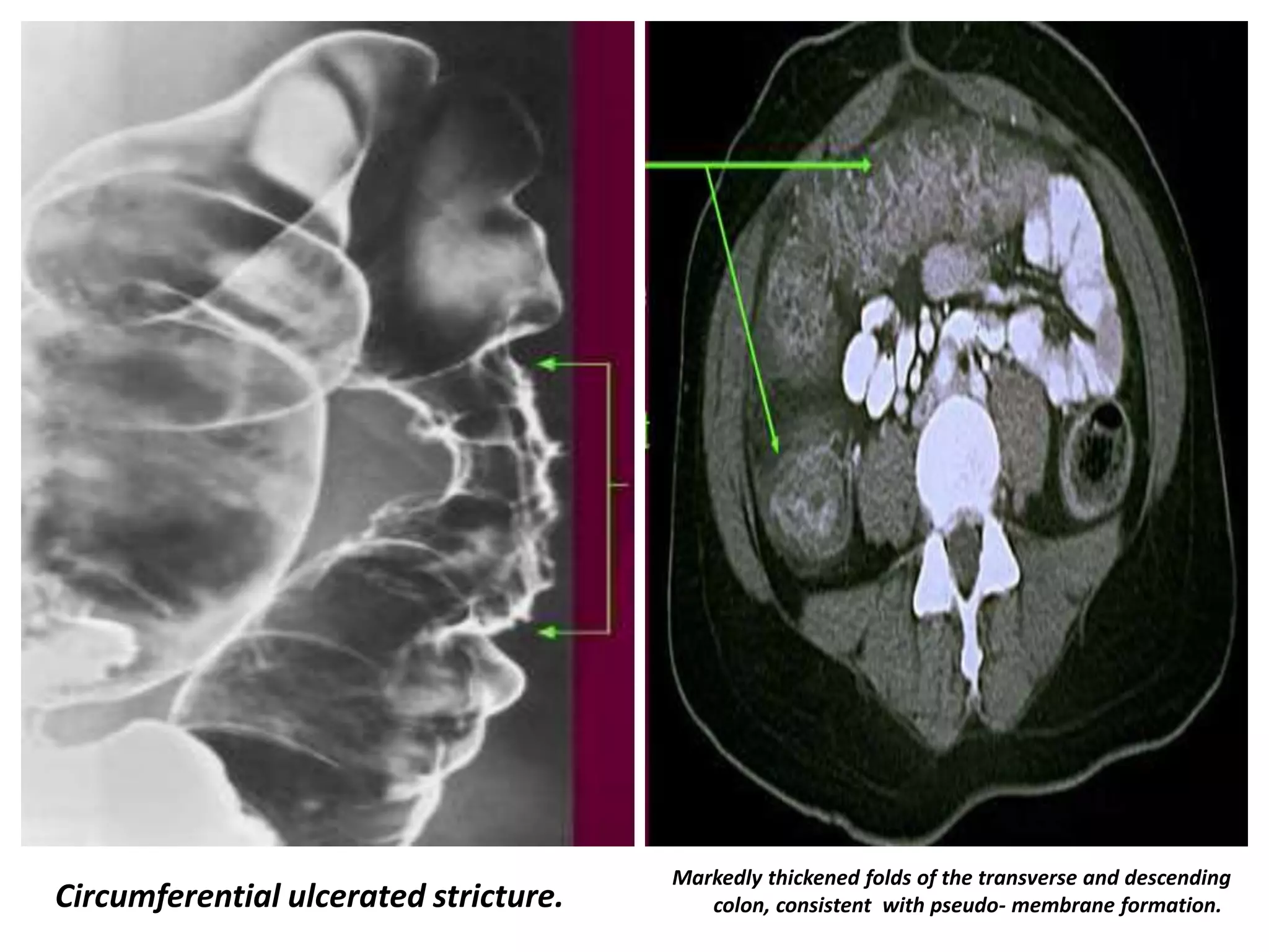 Presentation1, radiological imaging of colitis. | PPTX