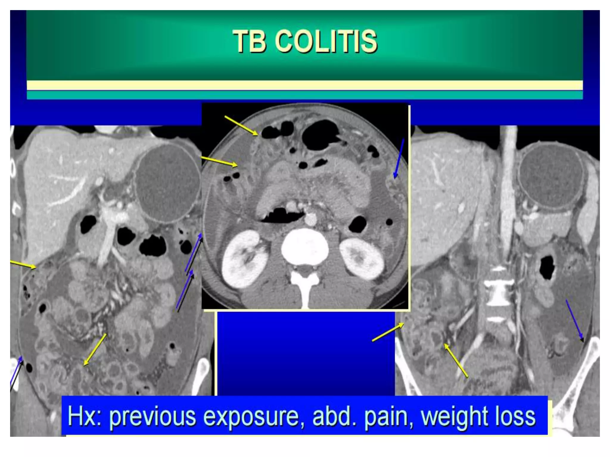 Presentation1, radiological imaging of colitis. | PPTX