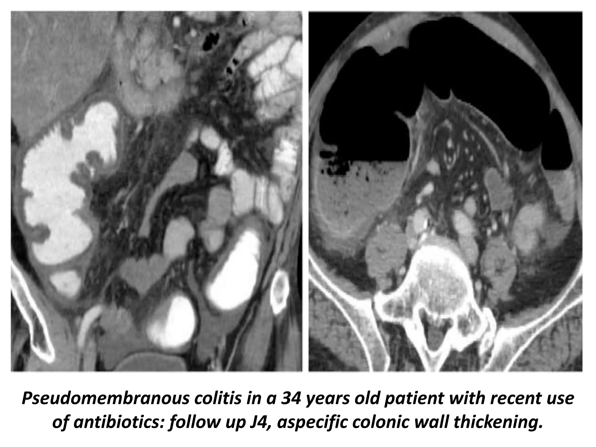 Presentation1, radiological imaging of colitis. | PPTX