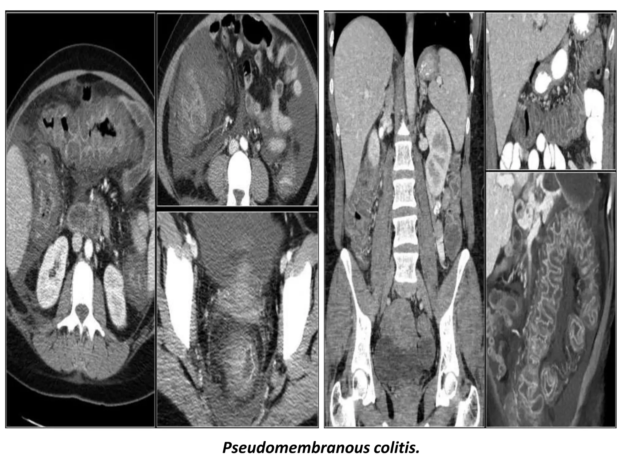Presentation1, radiological imaging of colitis. | PPTX