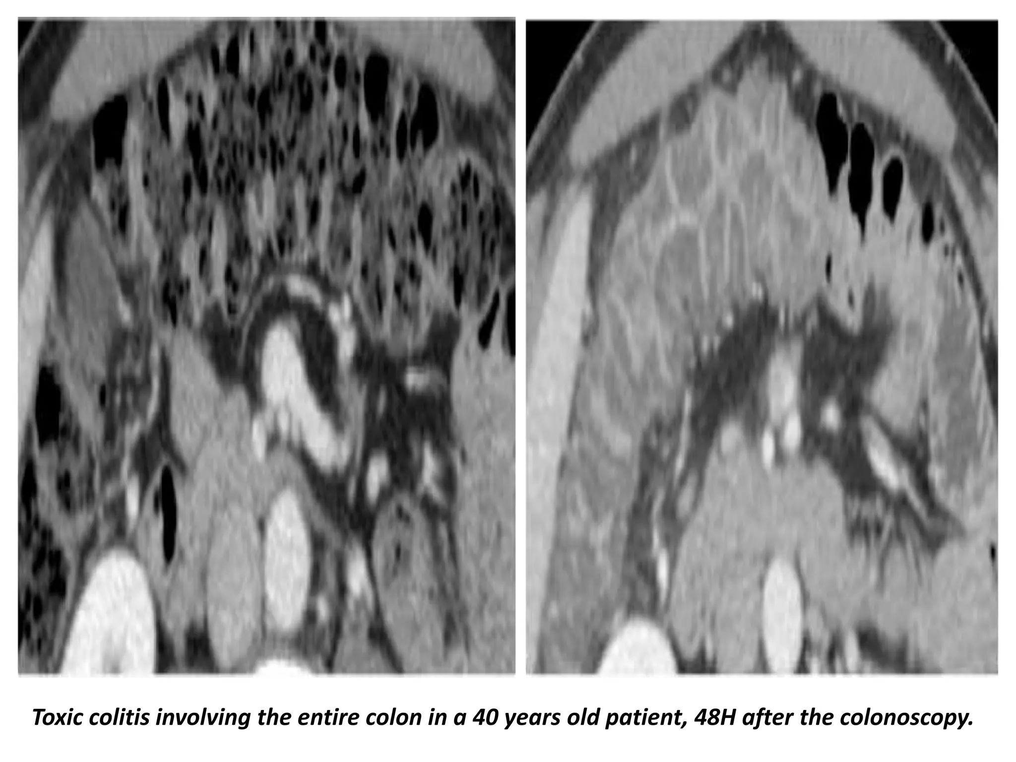 Presentation1, radiological imaging of colitis. | PPTX