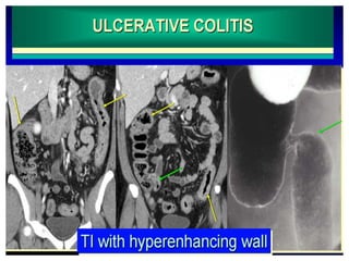 Presentation1, radiological imaging of colitis. | PPTX