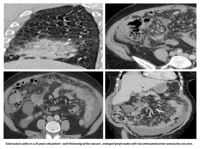 Presentation1, radiological imaging of colitis. | PPTX