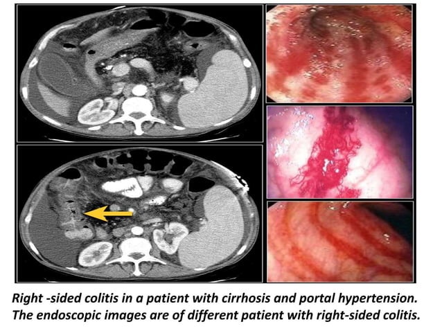 Presentation1, radiological imaging of colitis. | PPTX