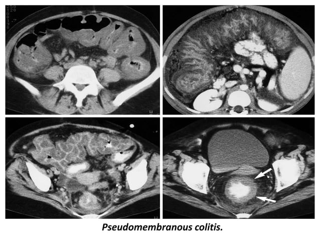 Presentation1, radiological imaging of colitis. | PPTX