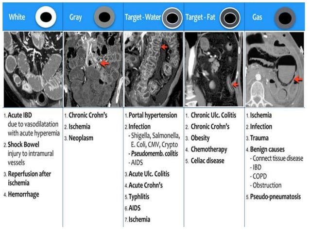 Presentation1, radiological imaging of colitis. | PPTX