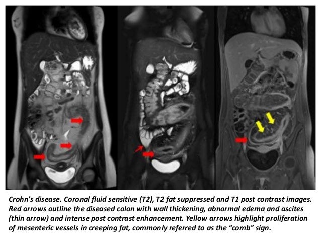 Presentation1, radiological imaging of colitis.