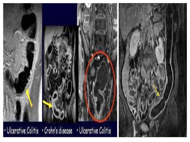 Presentation1, radiological imaging of colitis.