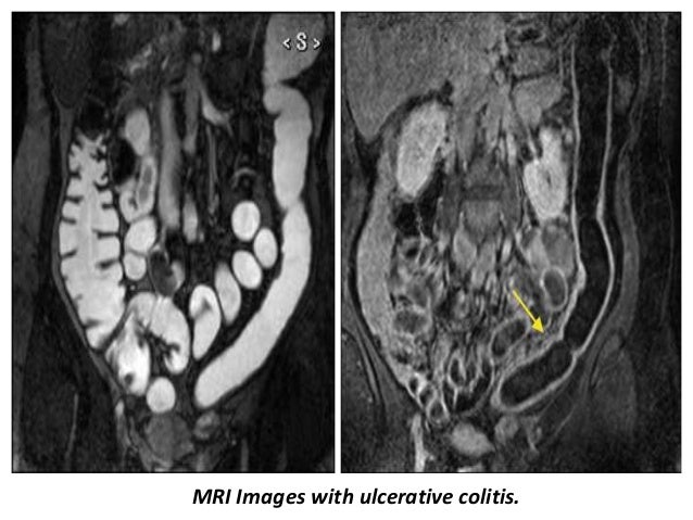 Presentation1, radiological imaging of colitis.