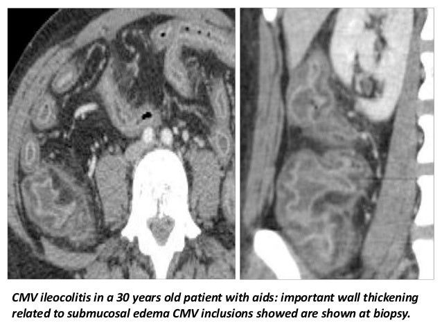 Presentation1, radiological imaging of colitis.