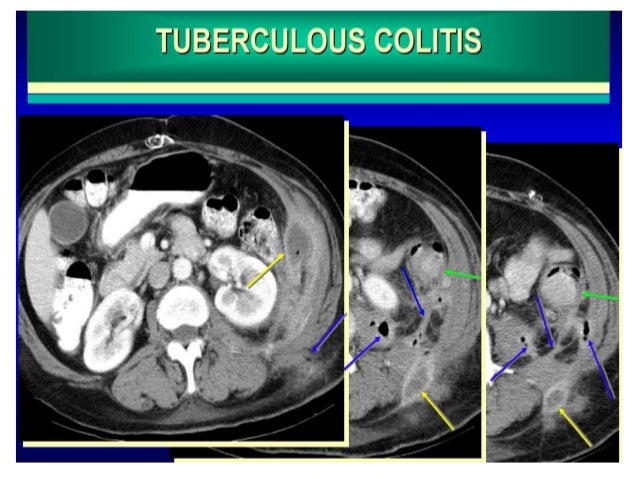Presentation1, radiological imaging of colitis.