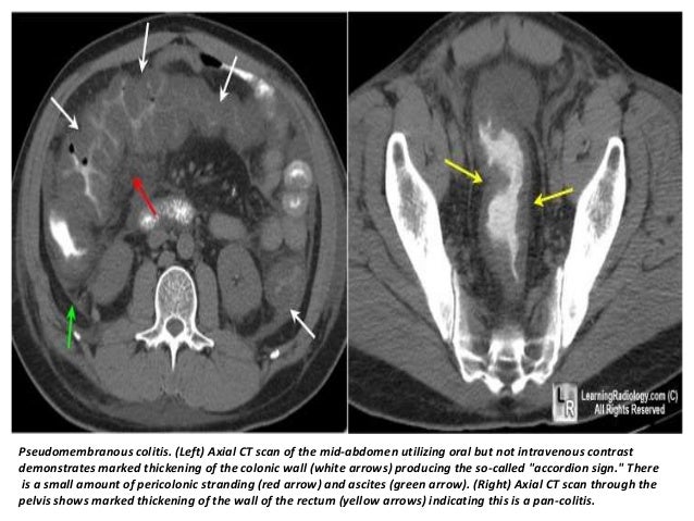 Presentation1, radiological imaging of colitis.