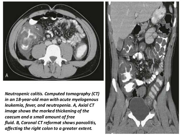 Presentation1, radiological imaging of colitis.