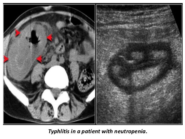 Presentation1, radiological imaging of colitis.