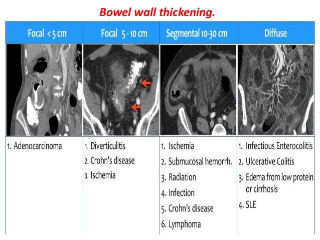 Presentation1, radiological imaging of colitis.
