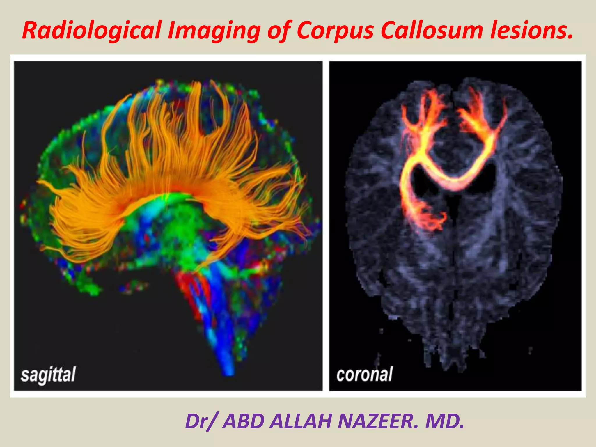 Presentation1, radiological imaging of corpus callosum lesios. | PPTX