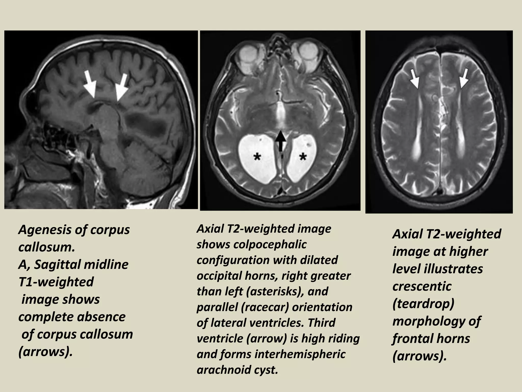 Presentation1, radiological imaging of corpus callosum lesios. | PPTX