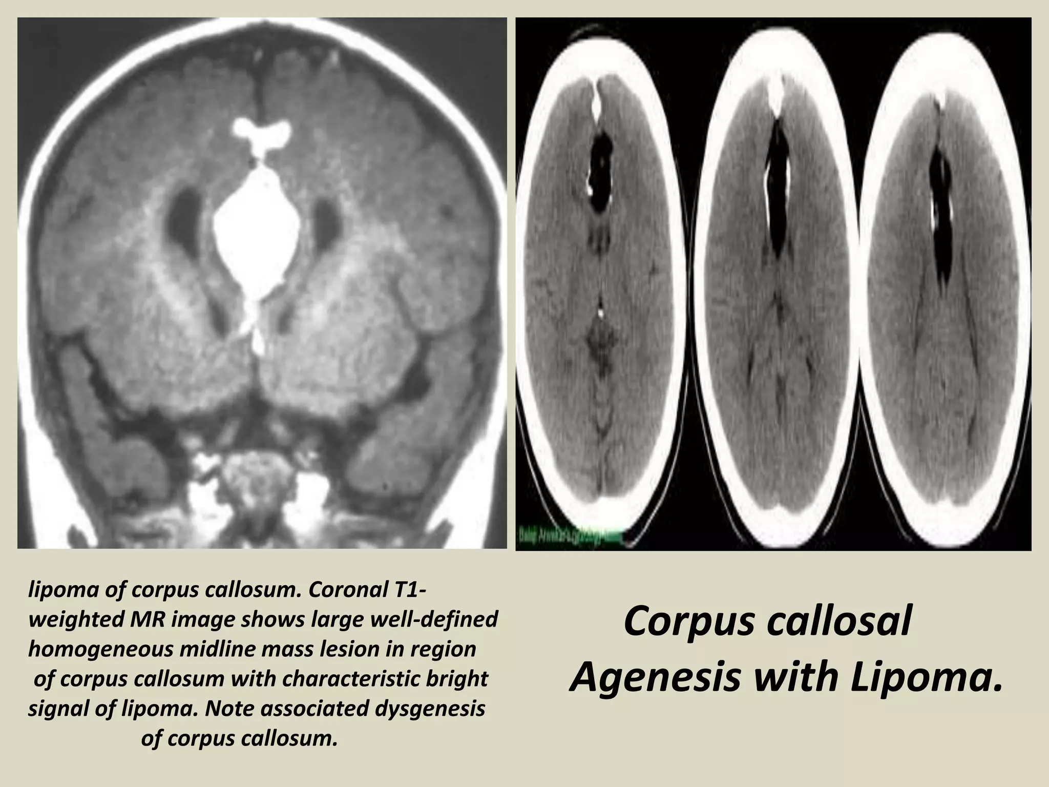 Presentation1, radiological imaging of corpus callosum lesios. | PPTX