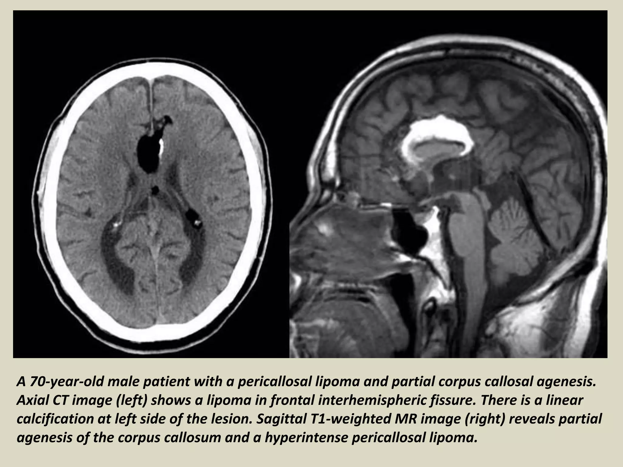 Presentation1, radiological imaging of corpus callosum lesios. | PPTX