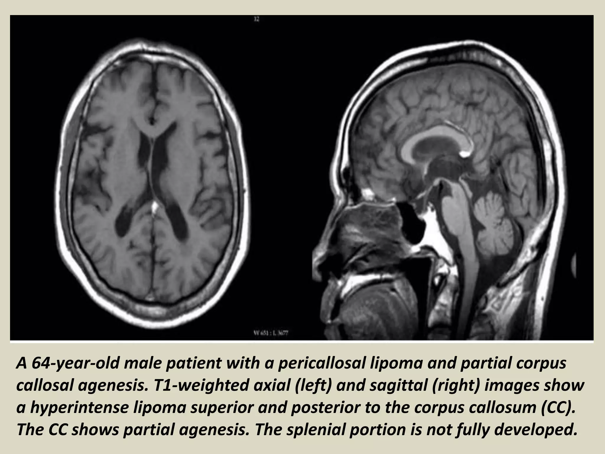 Presentation1, radiological imaging of corpus callosum lesios. | PPTX