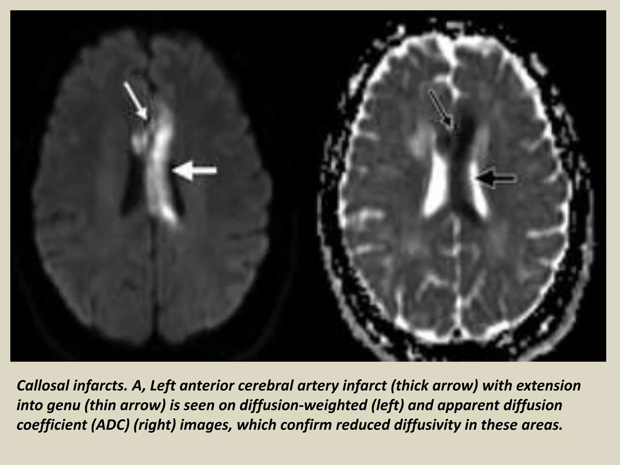 Presentation1, radiological imaging of corpus callosum lesios. | PPTX