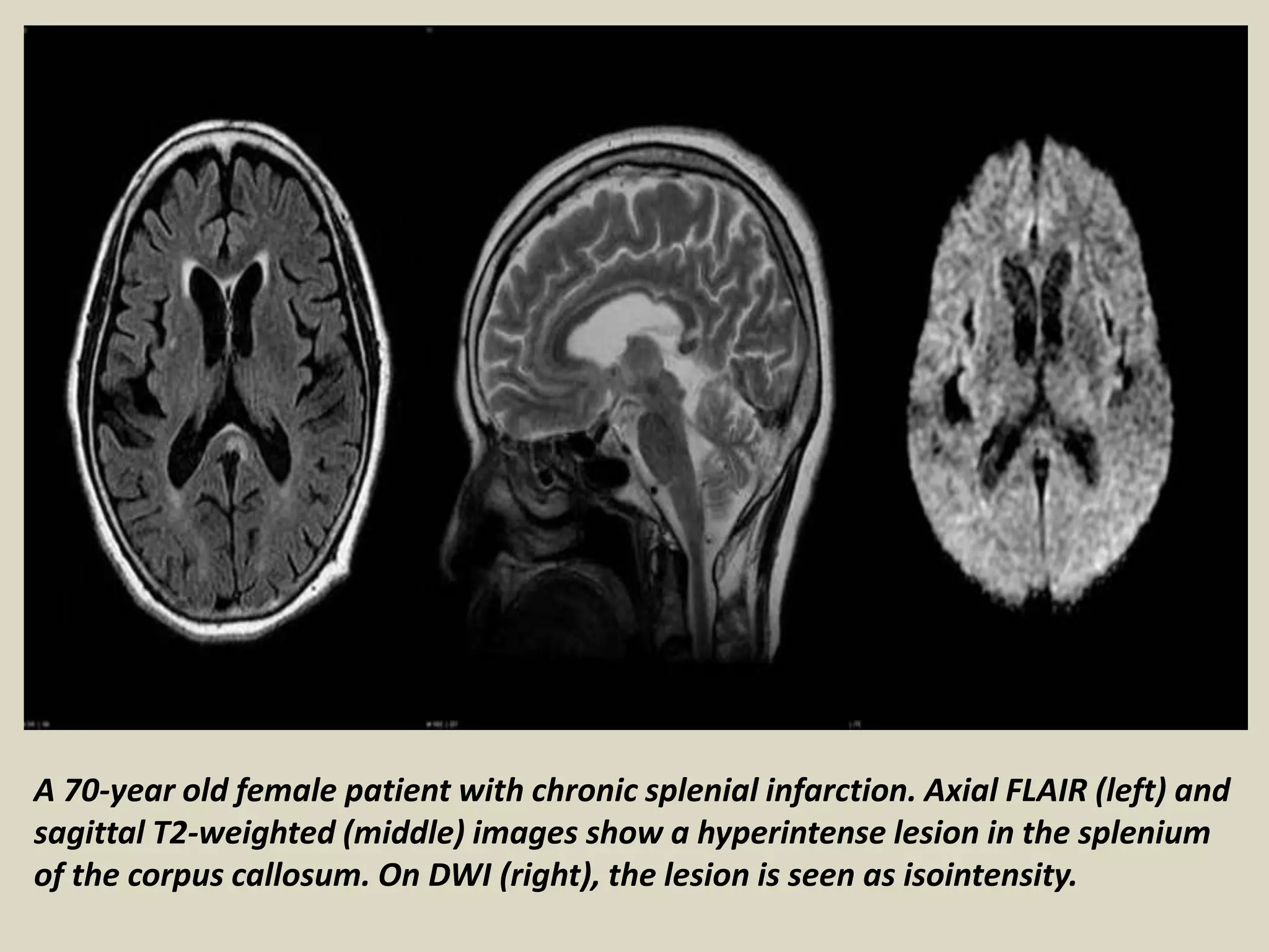 Presentation1, radiological imaging of corpus callosum lesios. | PPTX