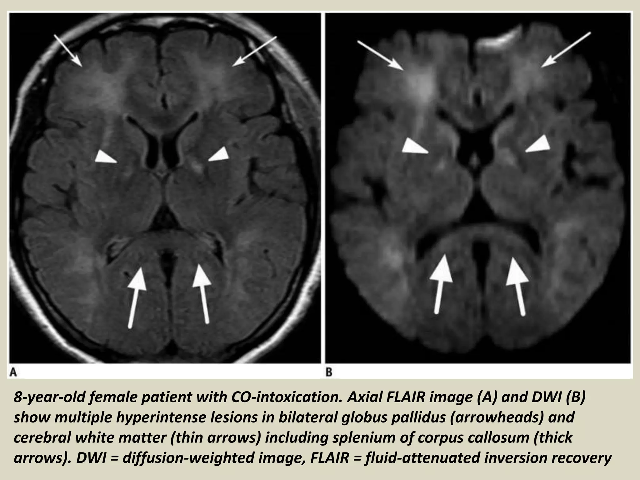 Presentation1, radiological imaging of corpus callosum lesios. | PPTX