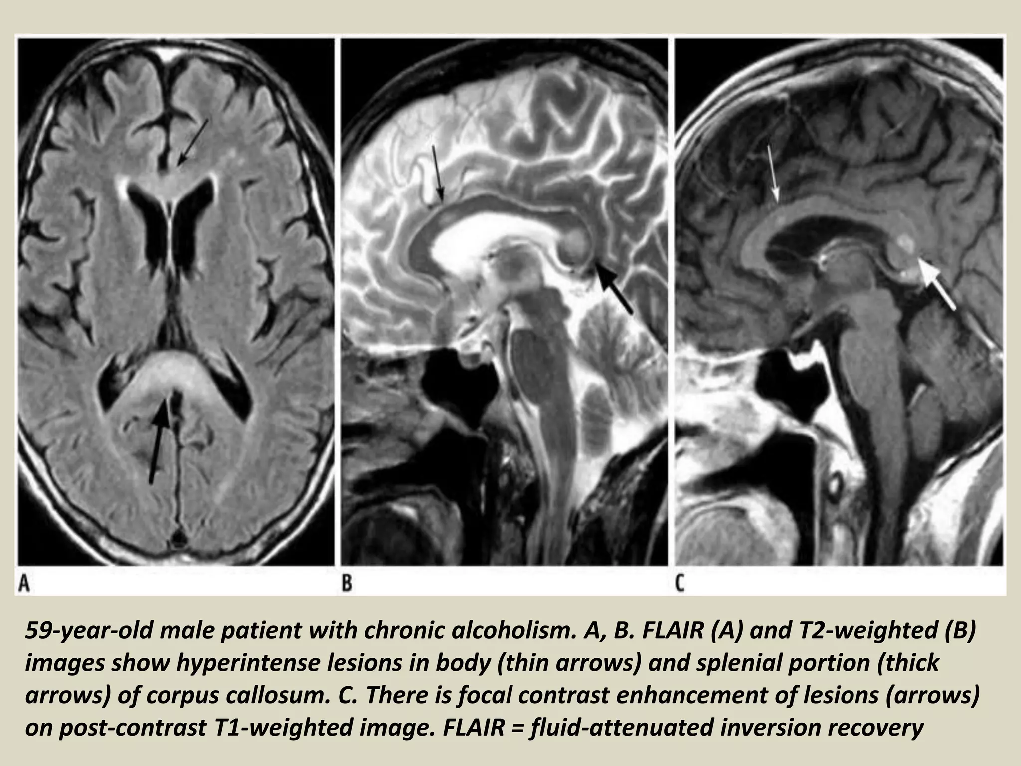 Presentation1, radiological imaging of corpus callosum lesios. | PPTX