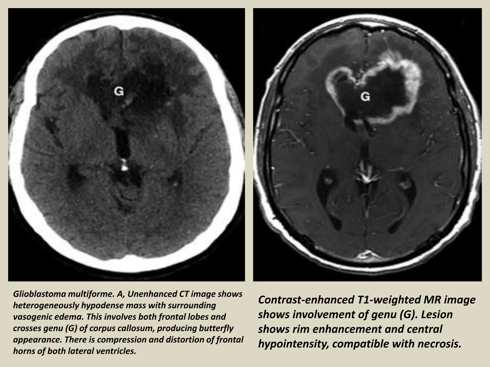 Presentation1, radiological imaging of corpus callosum lesios. | PPTX