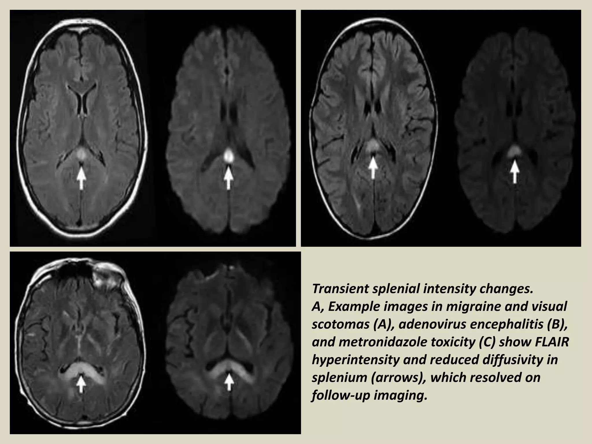 Presentation1, radiological imaging of corpus callosum lesios. | PPTX