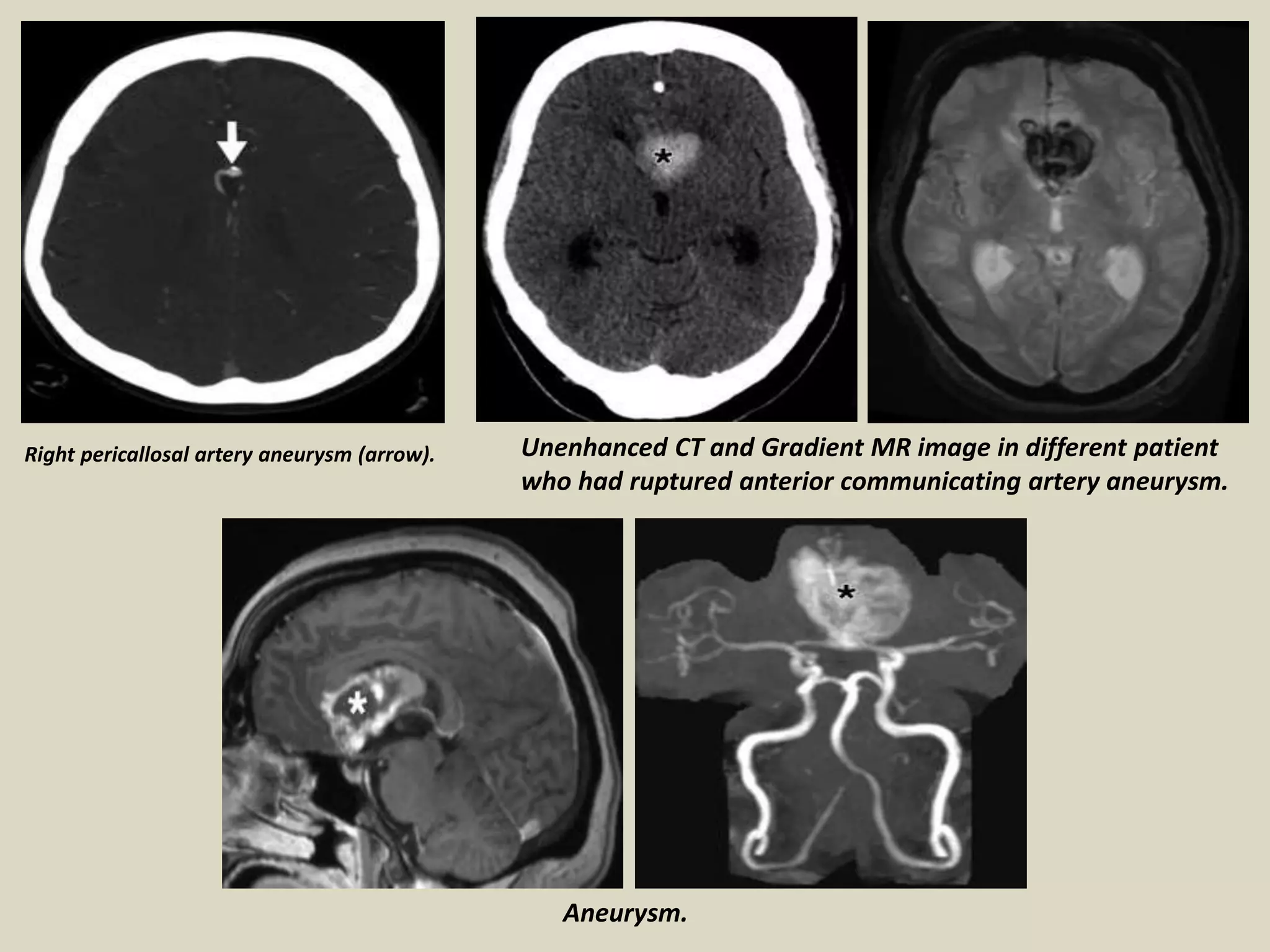 Presentation1, radiological imaging of corpus callosum lesios. | PPTX