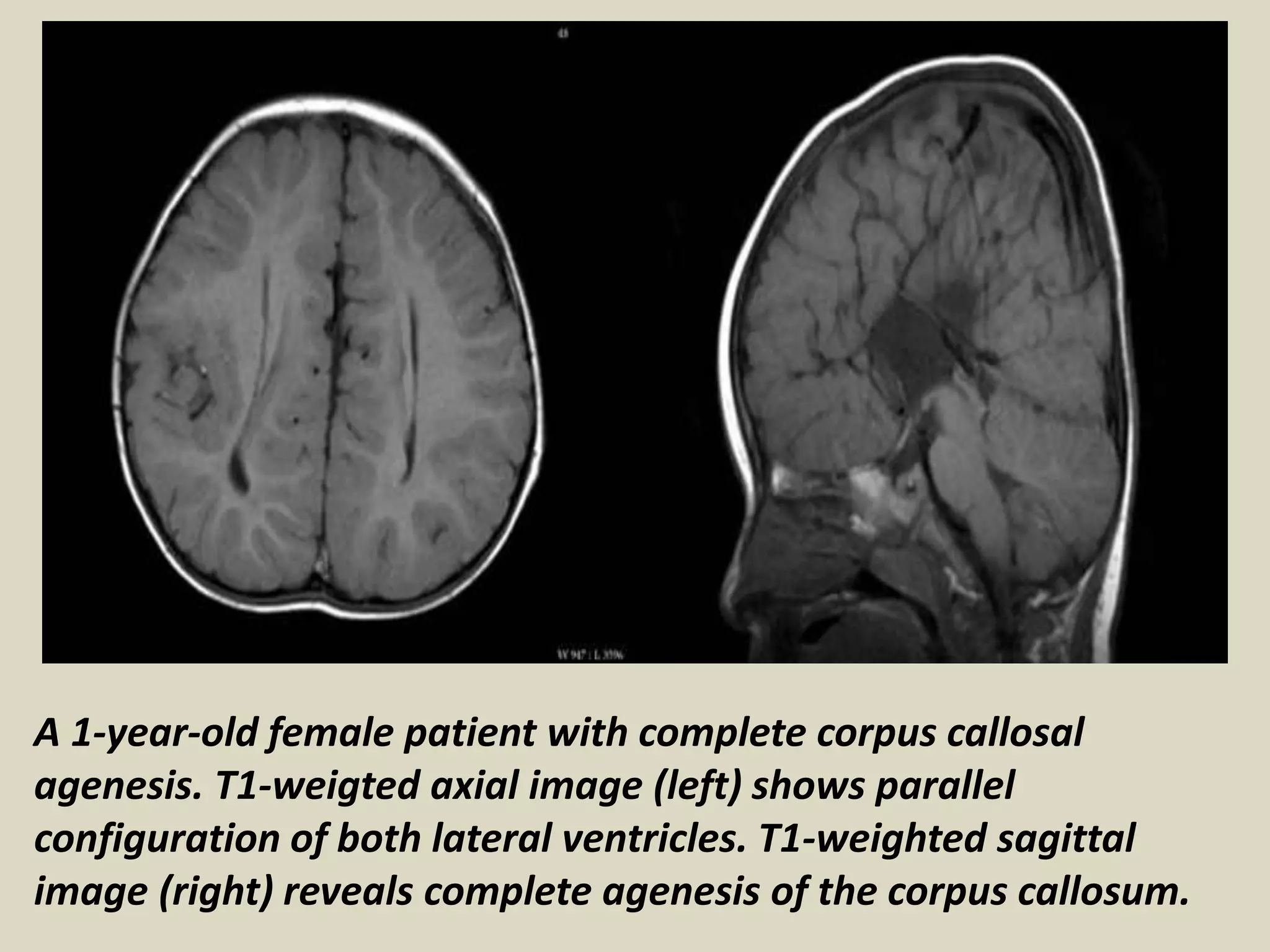 Presentation1, radiological imaging of corpus callosum lesios. | PPTX
