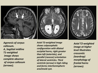 Corpus Callosum Mri
