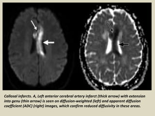 Corpus Callosum Infarct