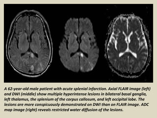 Corpus Callosum Infarct