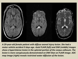 Corpus Callosum Mri Axial