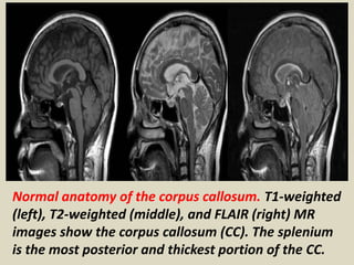 Corpus Callosum Mri Axial