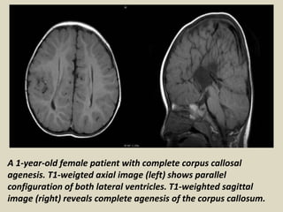 Complete Agenesis Of Corpus Callosum