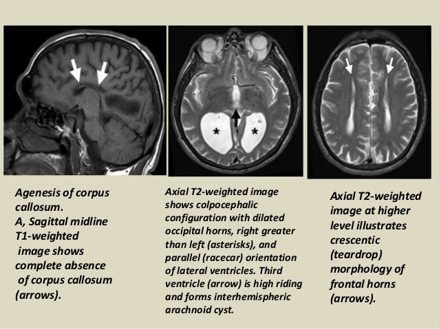 Presentation1, radiological imaging of corpus callosum lesios.