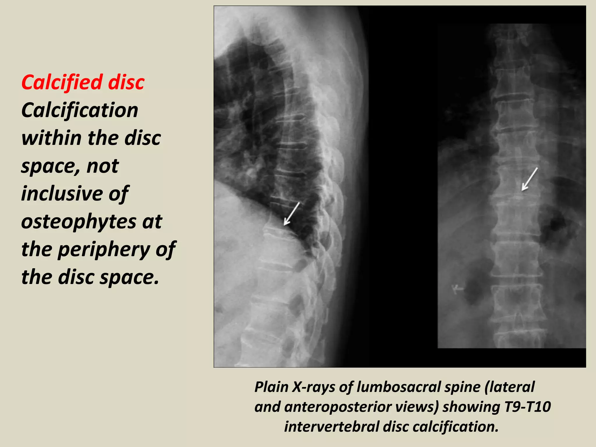 Presentation1, radiological imaging of degenerative and inflammatory ...